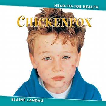 【】Chickenpox