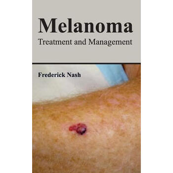 Melanoma: Treatment and Management