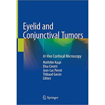 Eyelid and Conjunctival Tumors: In Vivo Confocal