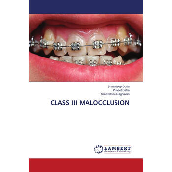 Class III Malocclusion