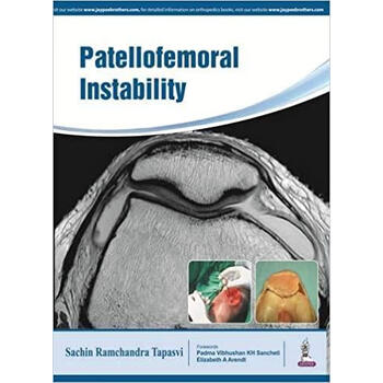 Patellofemoral Instability: Knee Joint